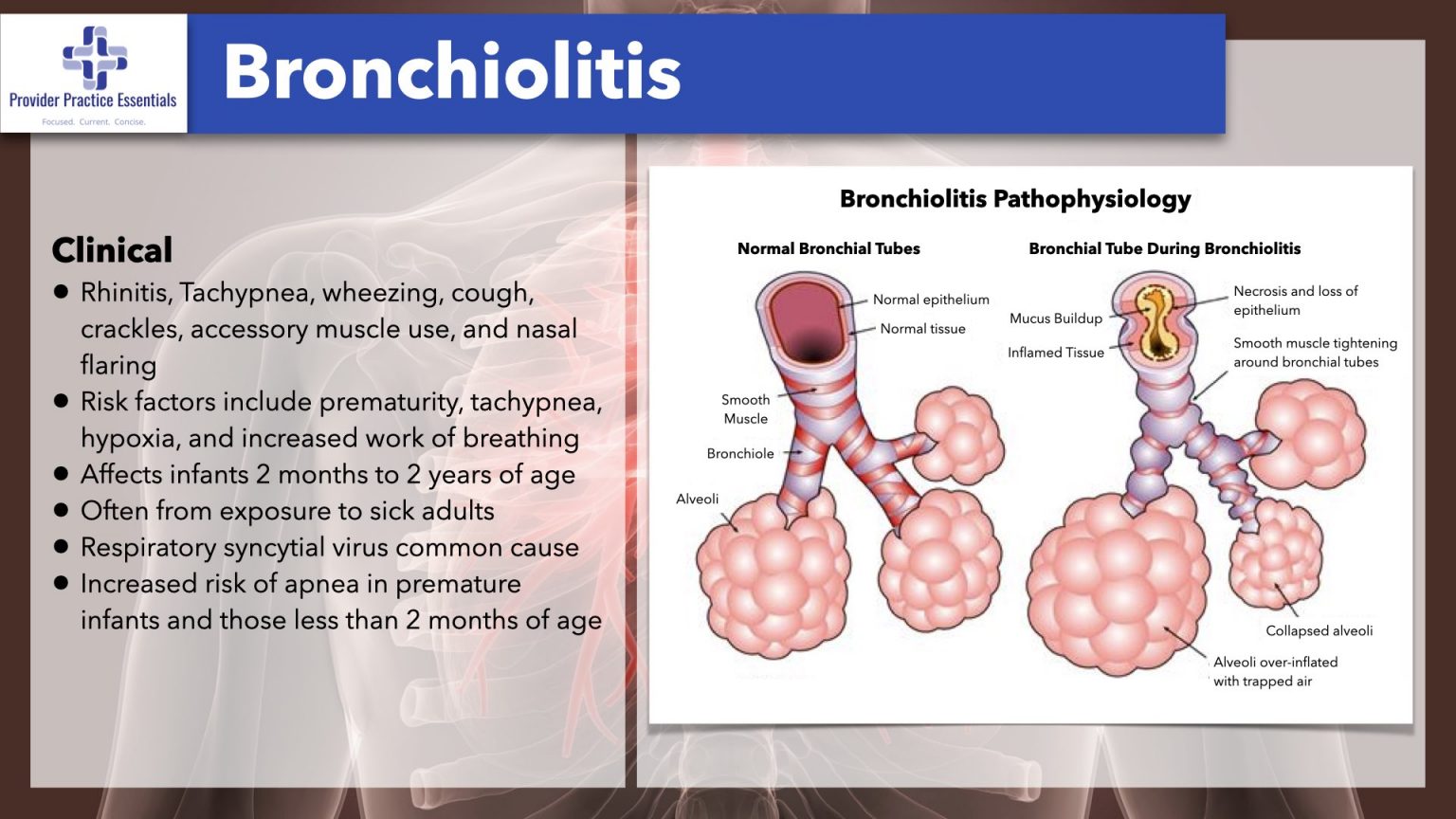 Bronchiolitis