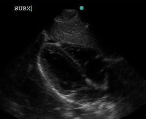 Ultrasound Series: The FAST Exam for unstable intra-abdominal bleeding