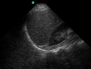 Ultrasound Series: The FAST Exam for unstable intra-abdominal bleeding