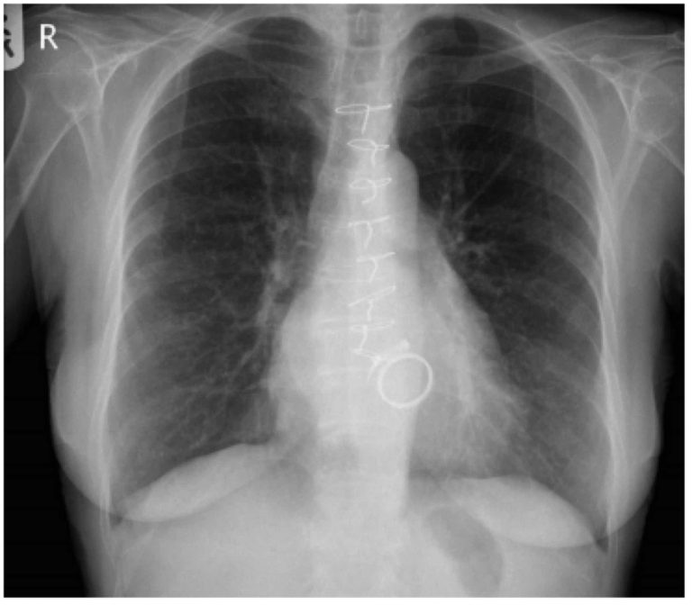 Basic Chest X-Ray Interpretation - Tips and pointers to see it all!