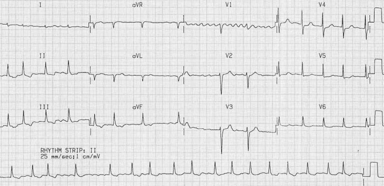 ECG Changes in Congestive Heart Failure