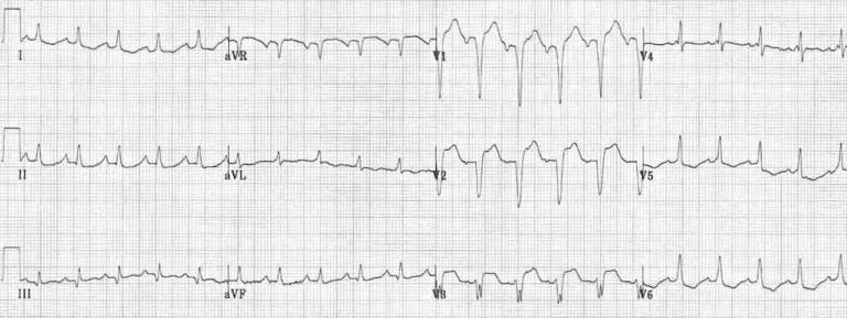 ECG Changes in Congestive Heart Failure