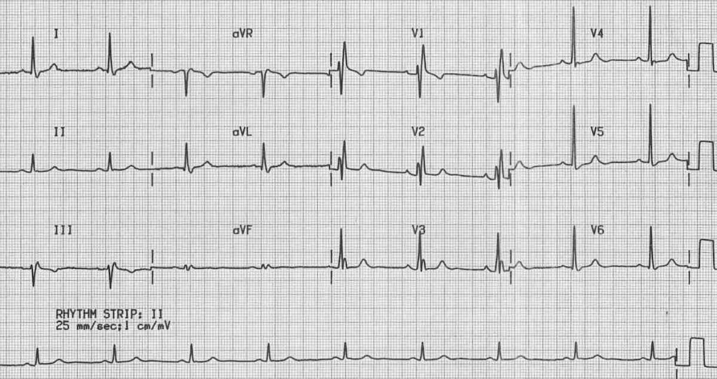 ECG Changes in Congestive Heart Failure